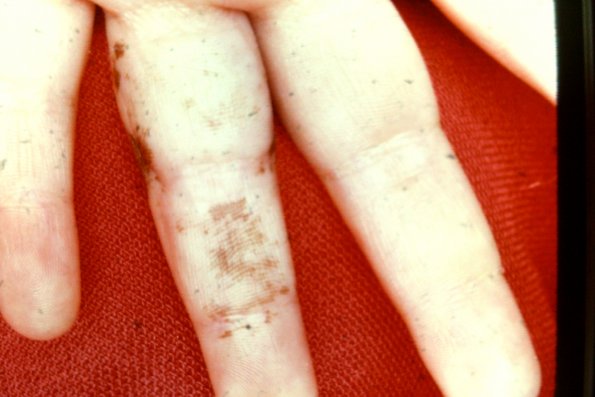 Lentigo Simplex (2) | Lentigo | Comprehensive Dermatology Photo Atlas ...