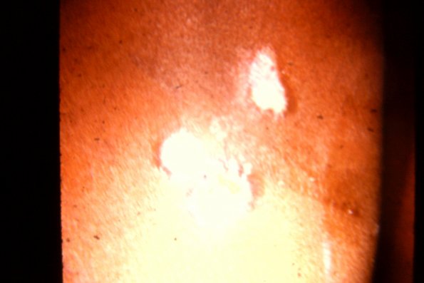 DLE (2) | Lupus | Comprehensive Dermatology Photo Atlas | Wayne State ...