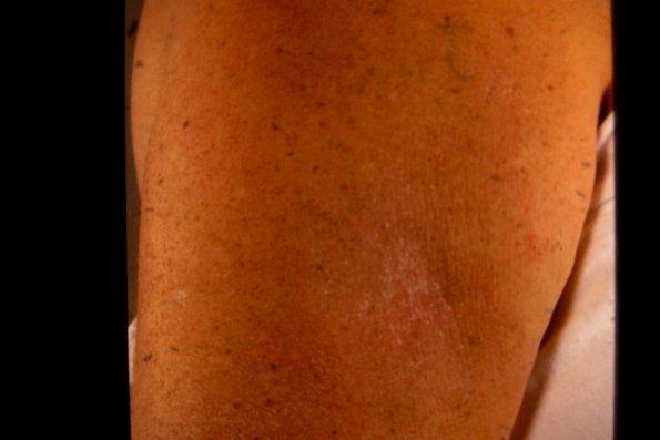 Lupus Profundus (3) | Lupus | Comprehensive Dermatology Photo Atlas ...