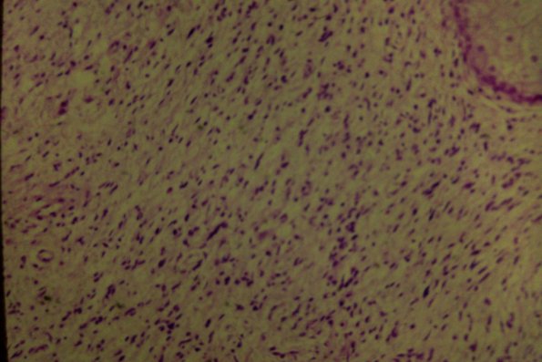 Neurofibrosarcoma (2) | Neurofibroma | Comprehensive Dermatology Photo ...