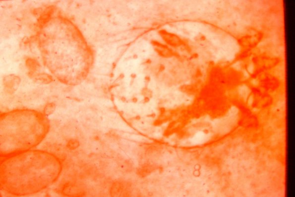 Scabies (3) | Scabies | Comprehensive Dermatology Photo Atlas | Wayne ...