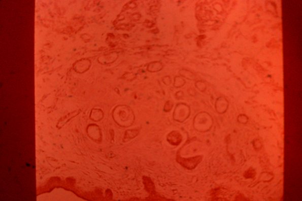 Syringoma (20) | Syringoma | Comprehensive Dermatology Photo Atlas ...