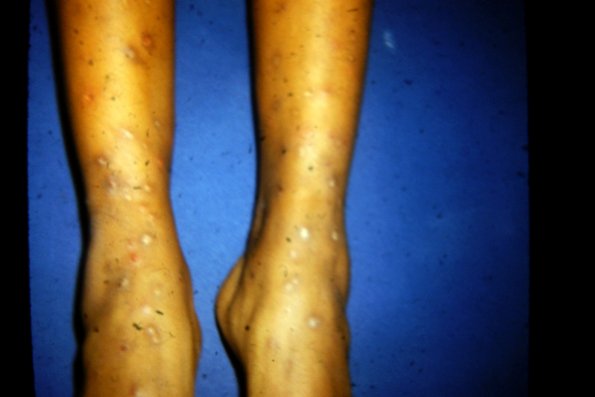 Papular Urticaria (6) | Urticaria | Comprehensive Dermatology Photo ...