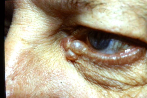 Hydrocystoma | Apocrine Hidrocystoma (Cystadenoma) | Dr. Robert J ...
