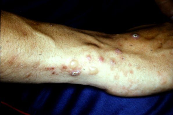 Dermatitis Herpetiformis (3) | Dermatitis Herpetiformis DH | Dr. Robert ...