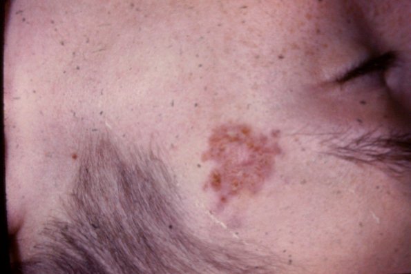 Lupus Vulgaris (12) | Lupus | Dr. Robert J. Schoenfeld | Wayne State ...