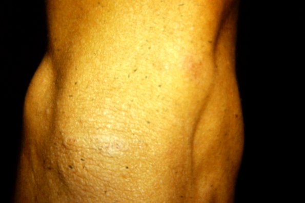 Scabies (10) | Scabies | Dr. Robert J. Schoenfeld | Wayne State ...