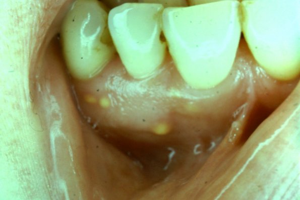 Xanthogranuloma (3) | xanthogranulom | Dr. Robert J. Schoenfeld | Wayne ...
